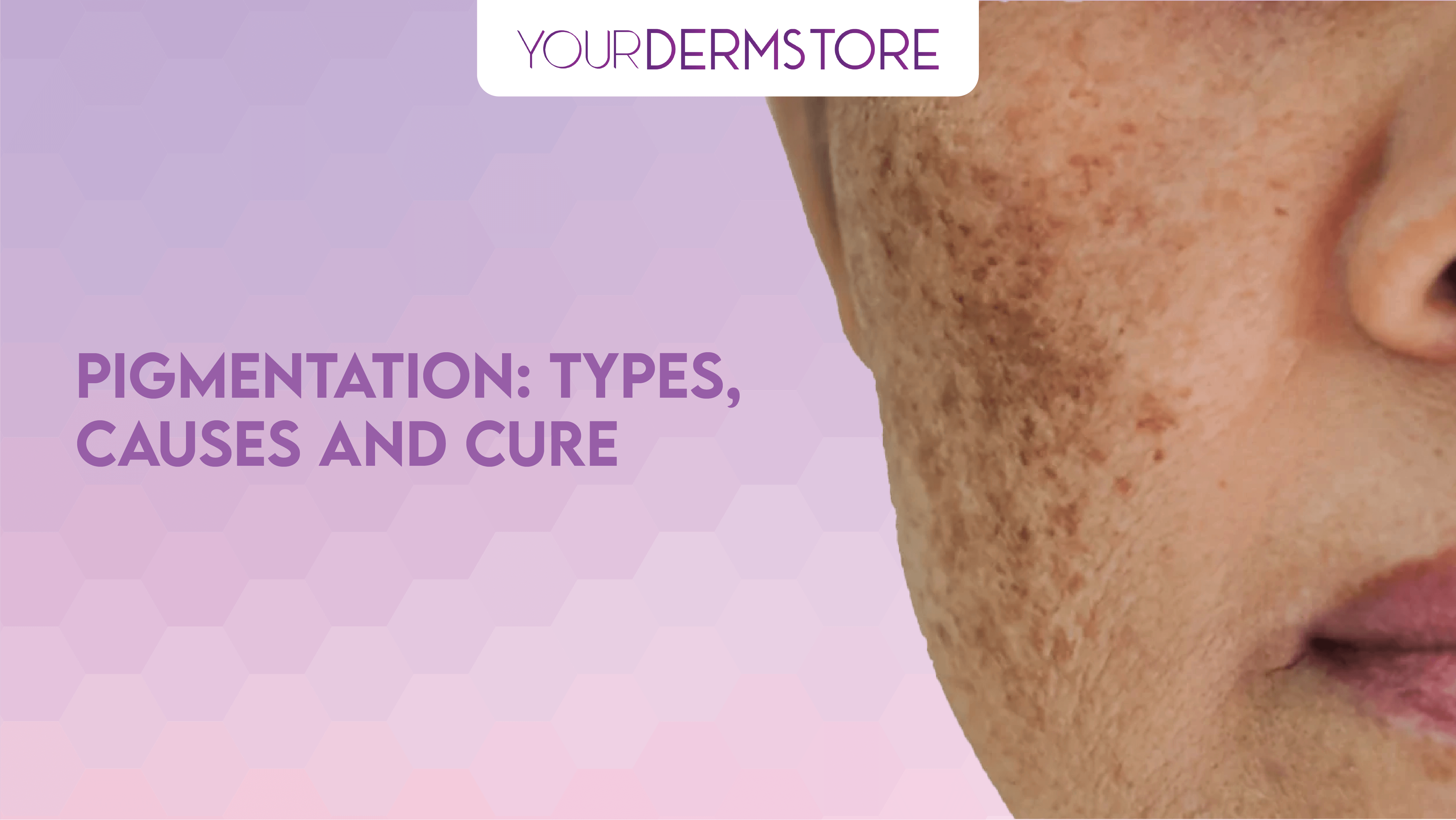 PIGMENTATION: TYPES, CAUSES AND CURE – yourdermstore